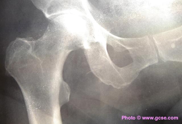 GCSE Physics: X-rays